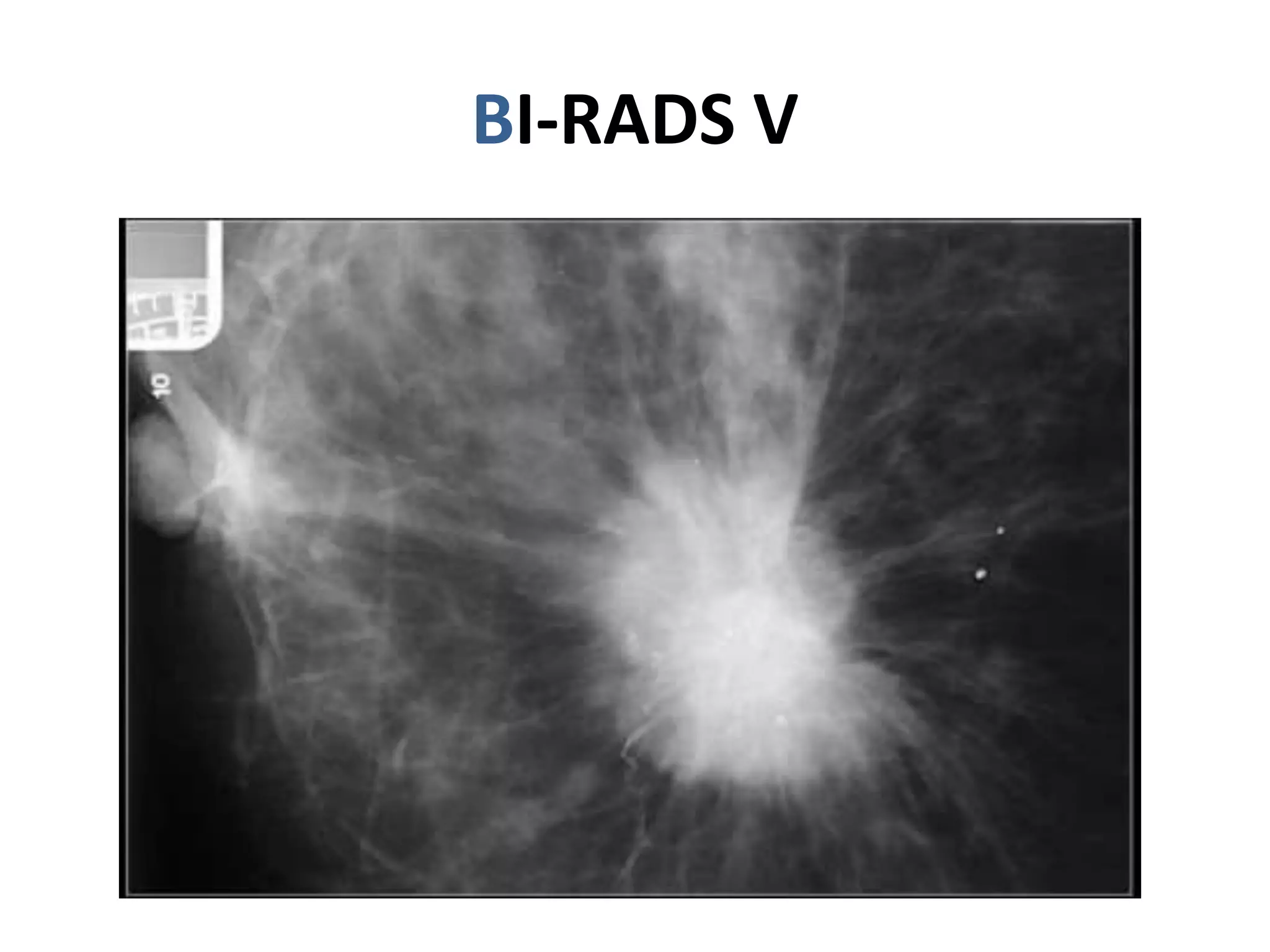Bi Rads Breast | PPTX