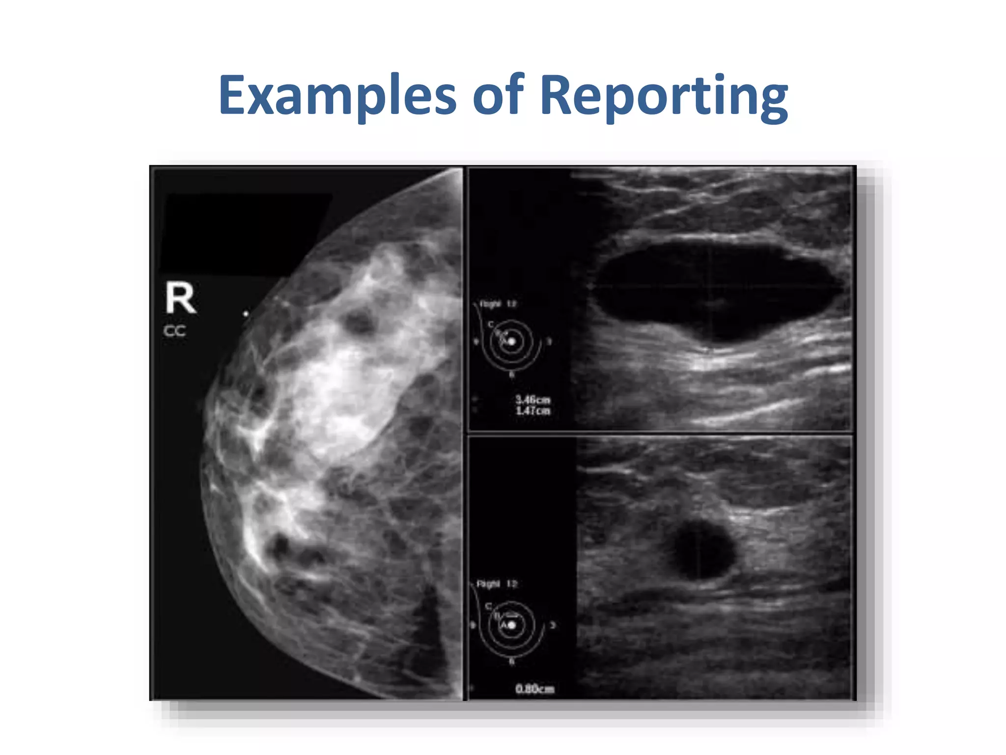 Bi Rads Breast | PPTX