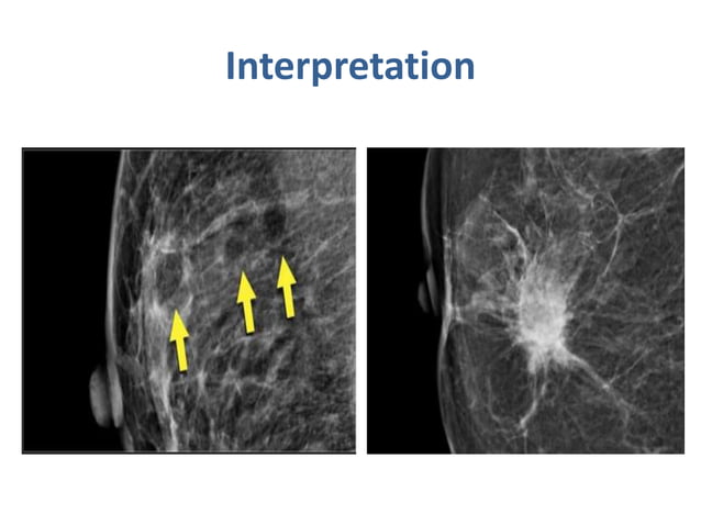 Bi Rads Breast | PPTX