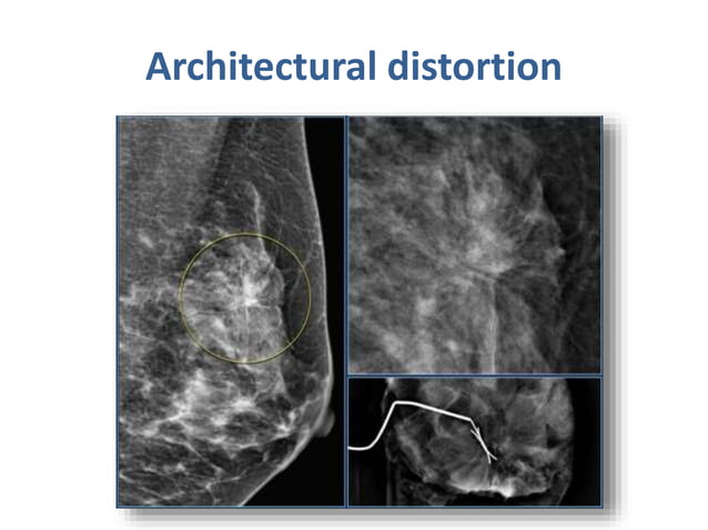 Bi Rads Breast | PPTX