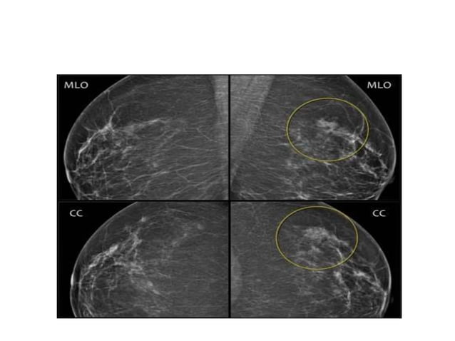 Bi Rads Breast | PPTX