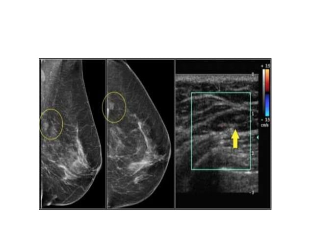 Bi Rads Breast | PPTX