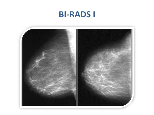 Bi Rads Breast | PPTX