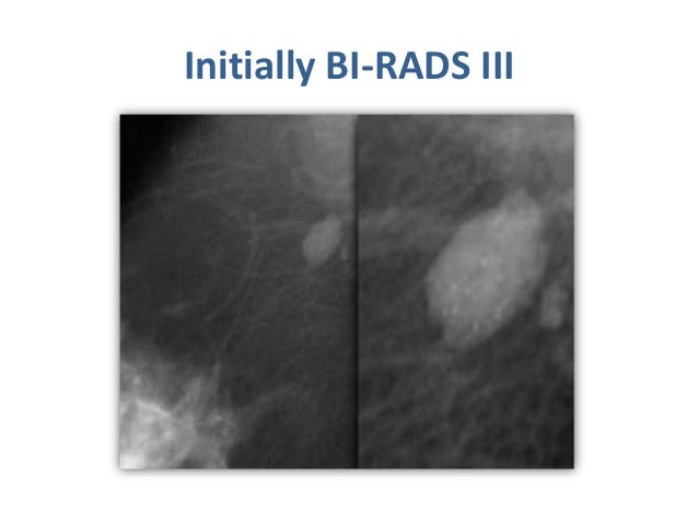 Bi Rads Breast