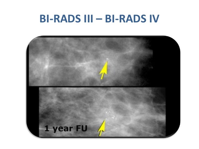 Bi Rads Breast