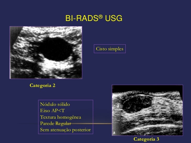 Bi rads 3, 4 e 5 – como conduzir