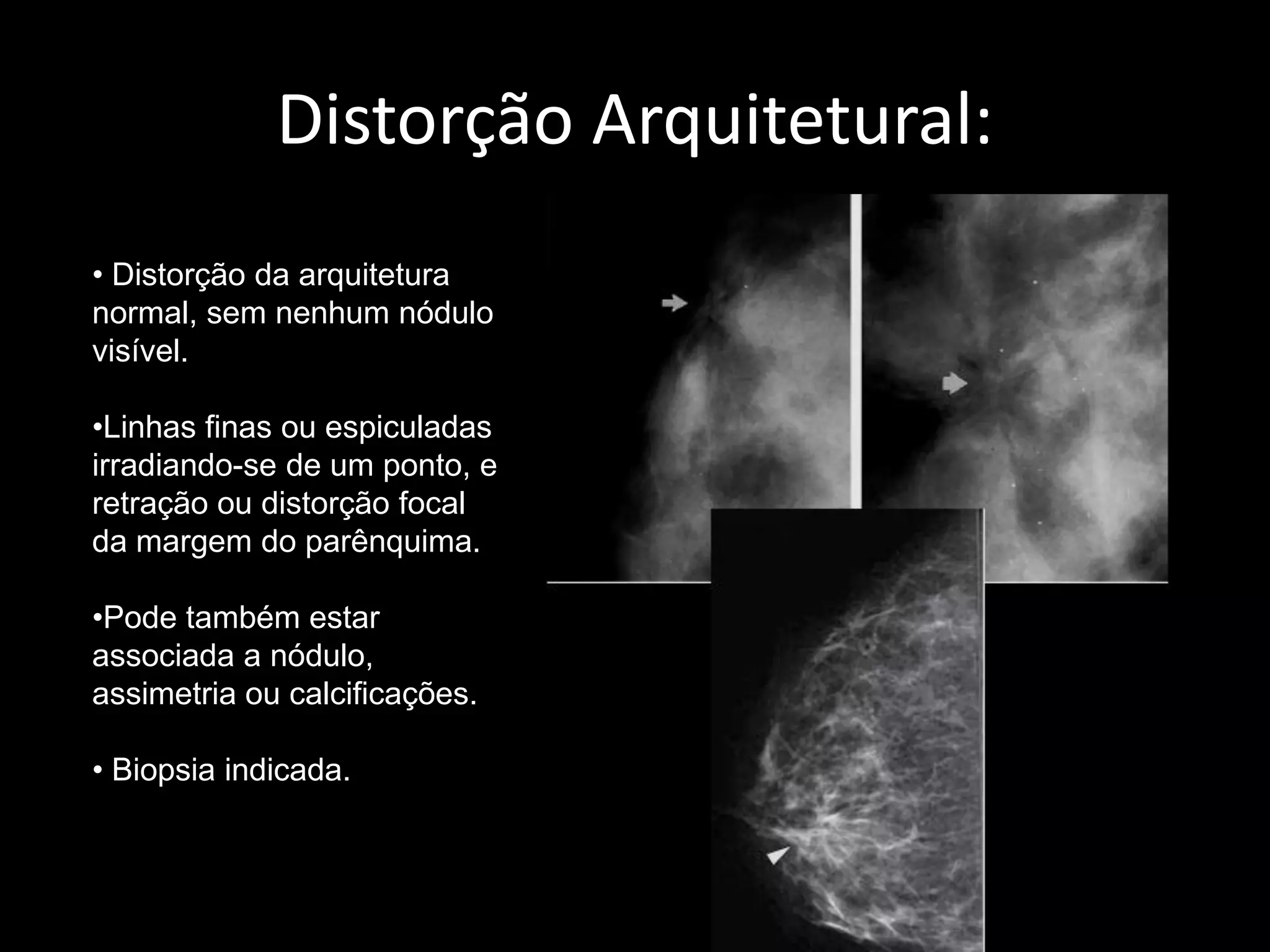 Bi rads - mamografia