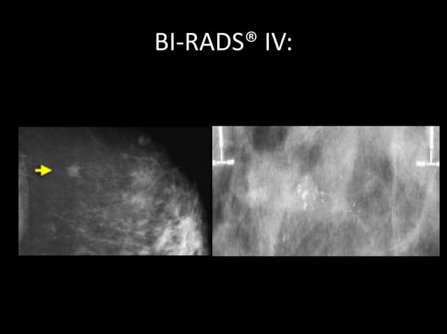 Bi rads - mamografia | PPT