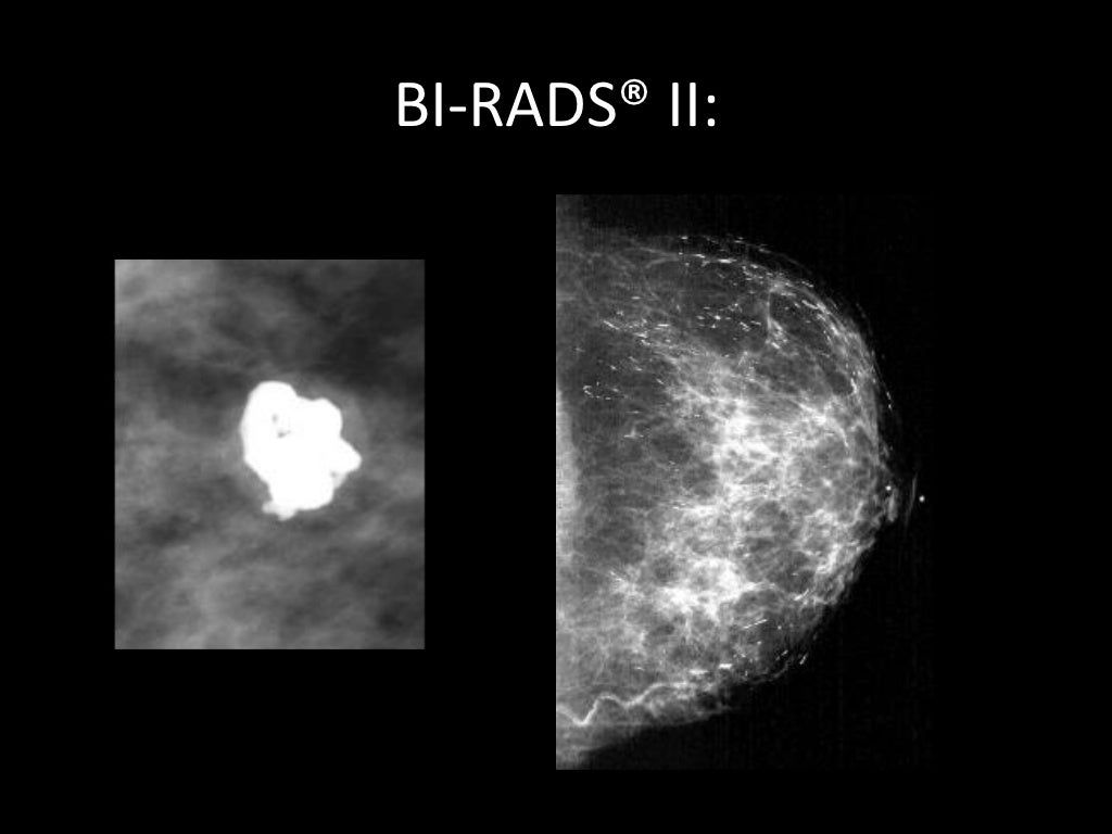 Bi rads - mamografia