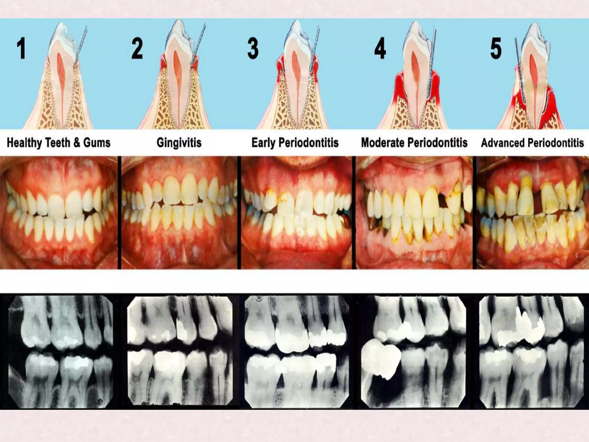 Gingival inflammation and features | PPTX