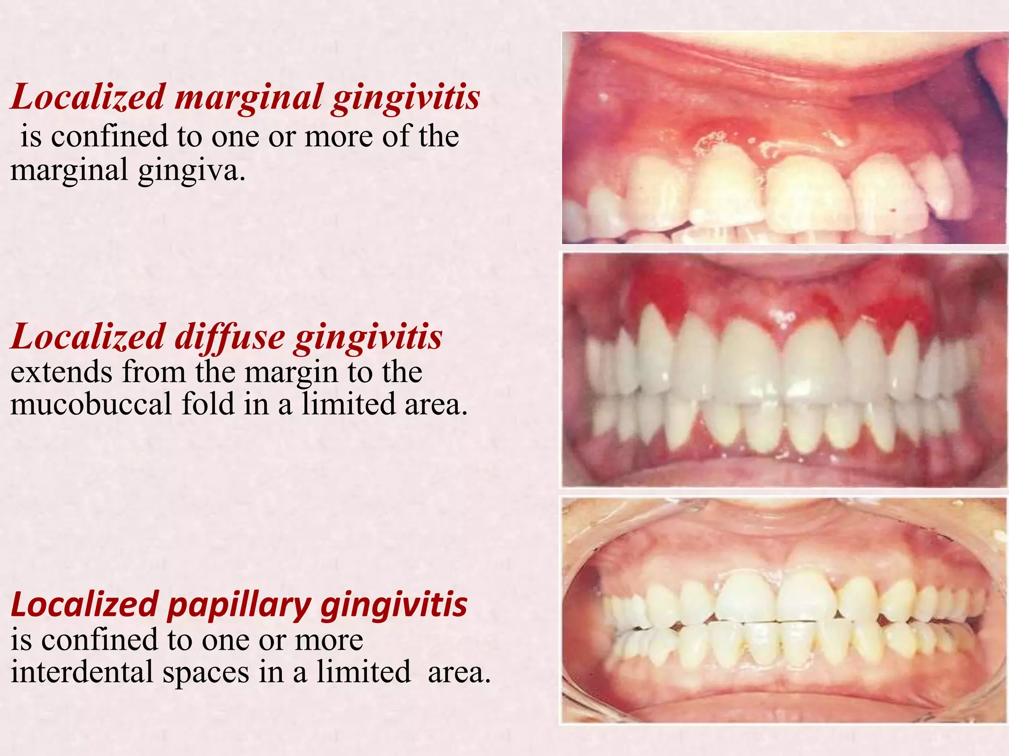Gingival inflammation and features | PPTX