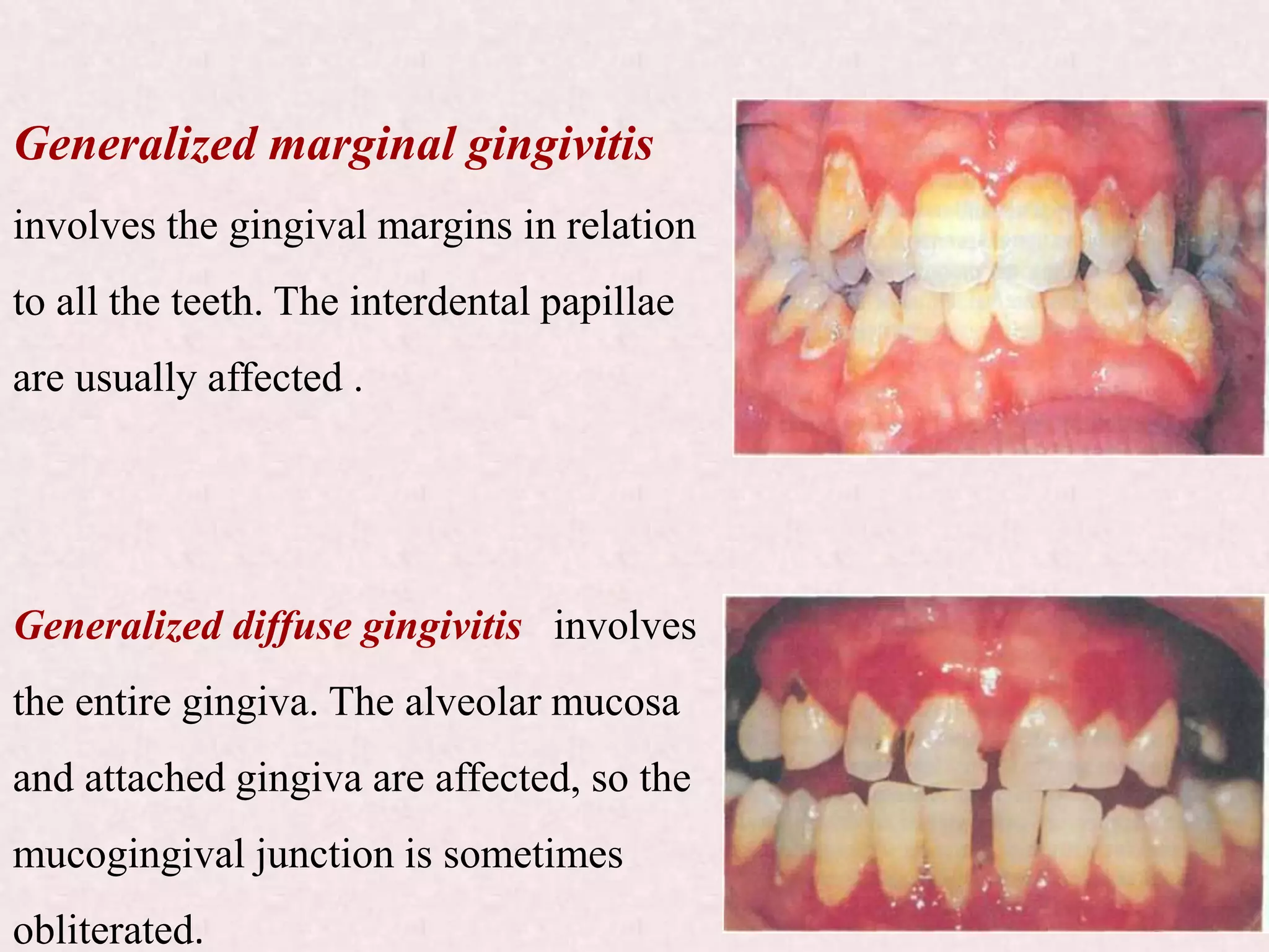 Gingival inflammation and features | PPTX