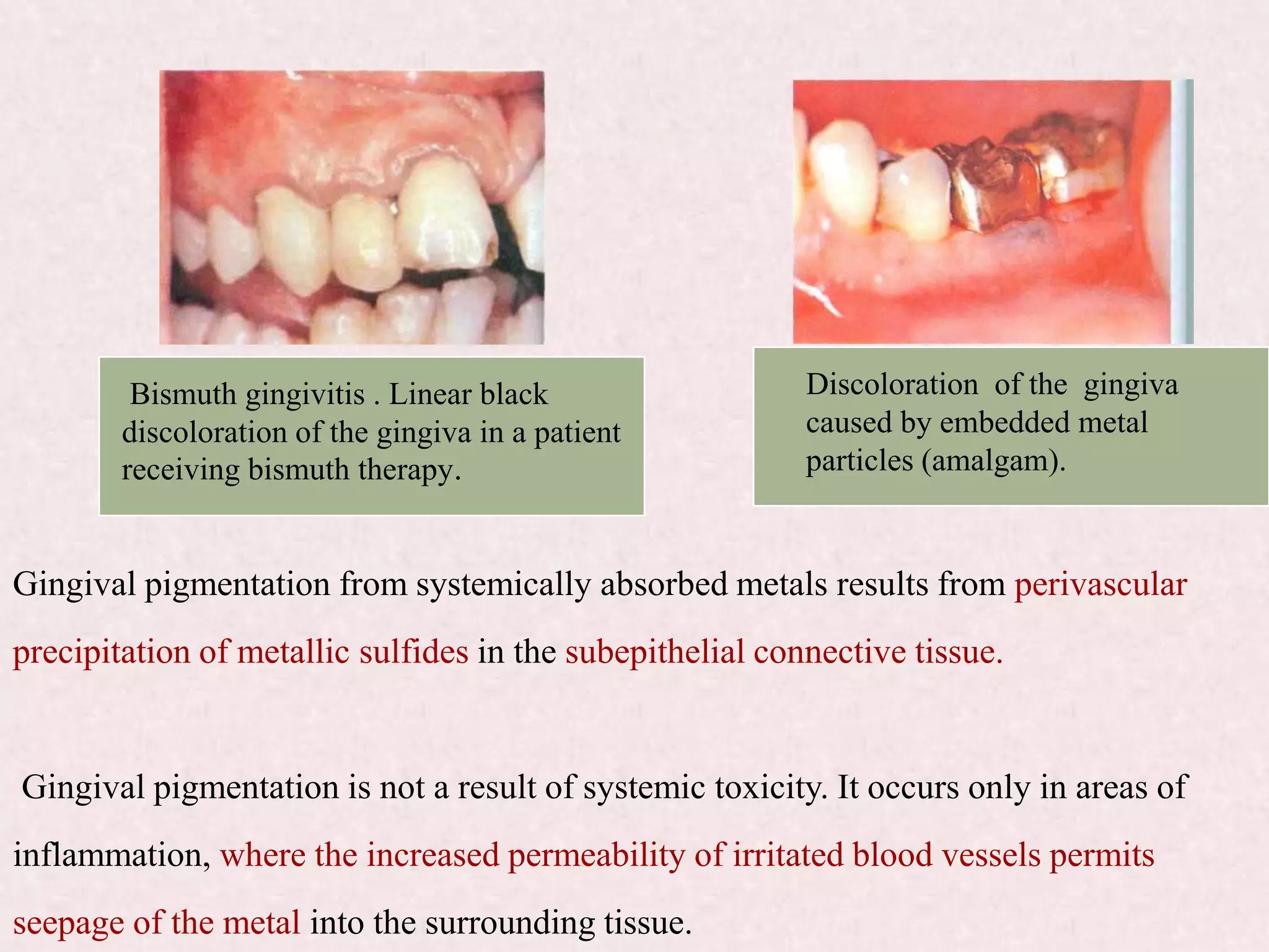 Gingival inflammation and features | PPTX