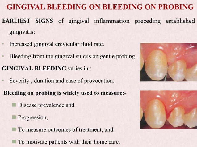 Gingival inflammation and features | PPTX