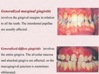 Gingival Margin
