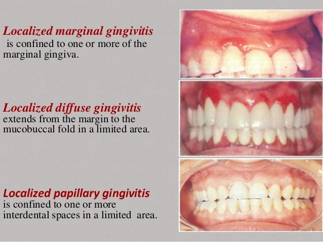 Gingival inflammation and features