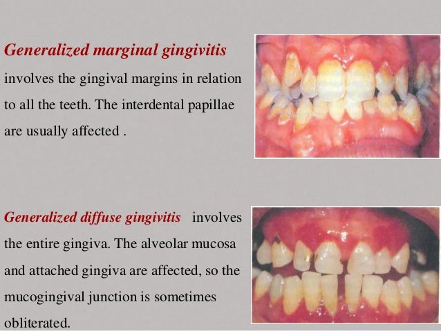 Gingival inflammation and features