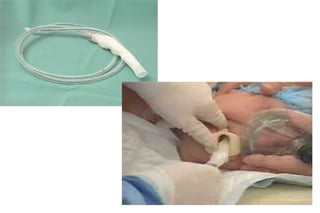 Intragastric Balloons for Treatment of Obesity | PPT