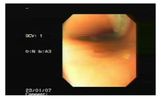 Intragastric Balloons for Treatment of Obesity | PPT
