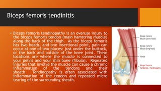 Bicep Femoris Tendinitis | PDF