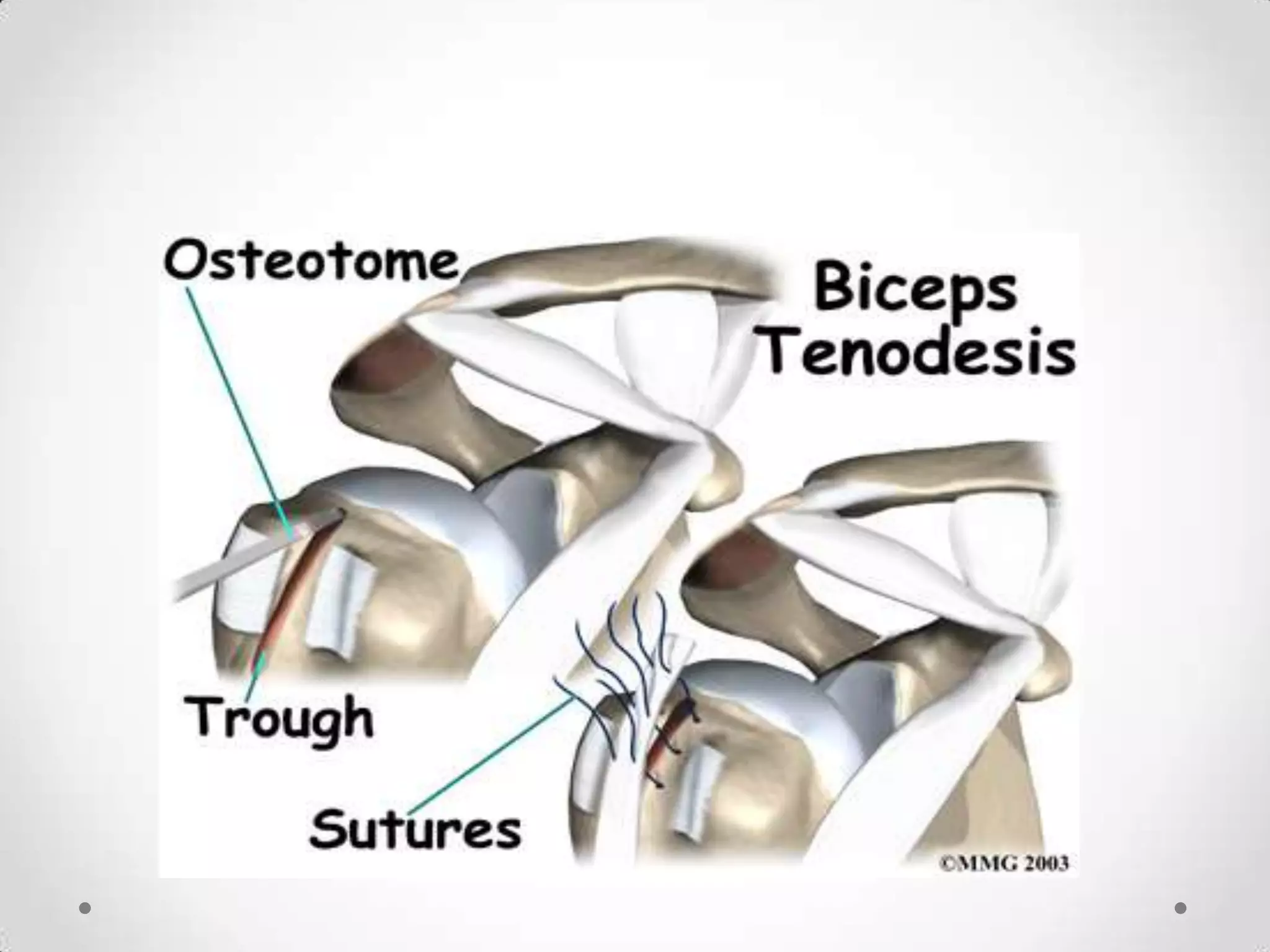 Biceps Tendon Rupture And Physiotherapy Management | PPTX