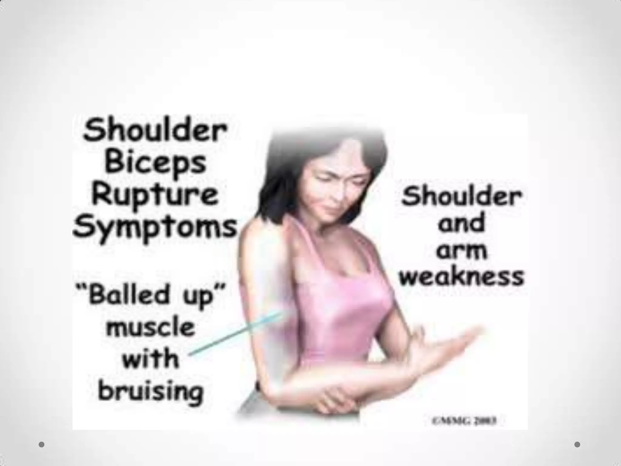 Biceps Tendon Rupture And Physiotherapy Management | PPTX