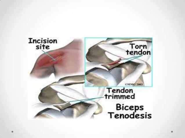 Biceps Tendon Rupture And Physiotherapy Management | PPTX