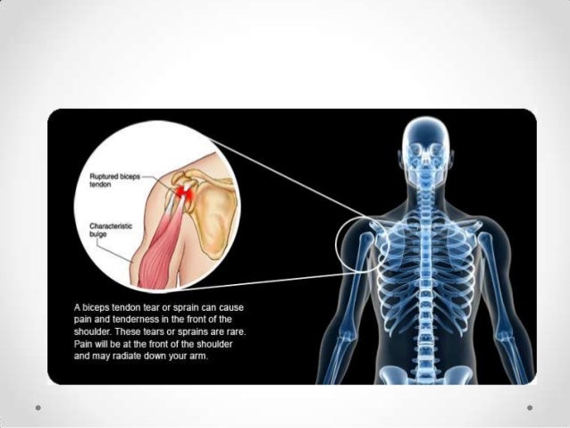 Biceps Tendon Rupture And Physiotherapy Management