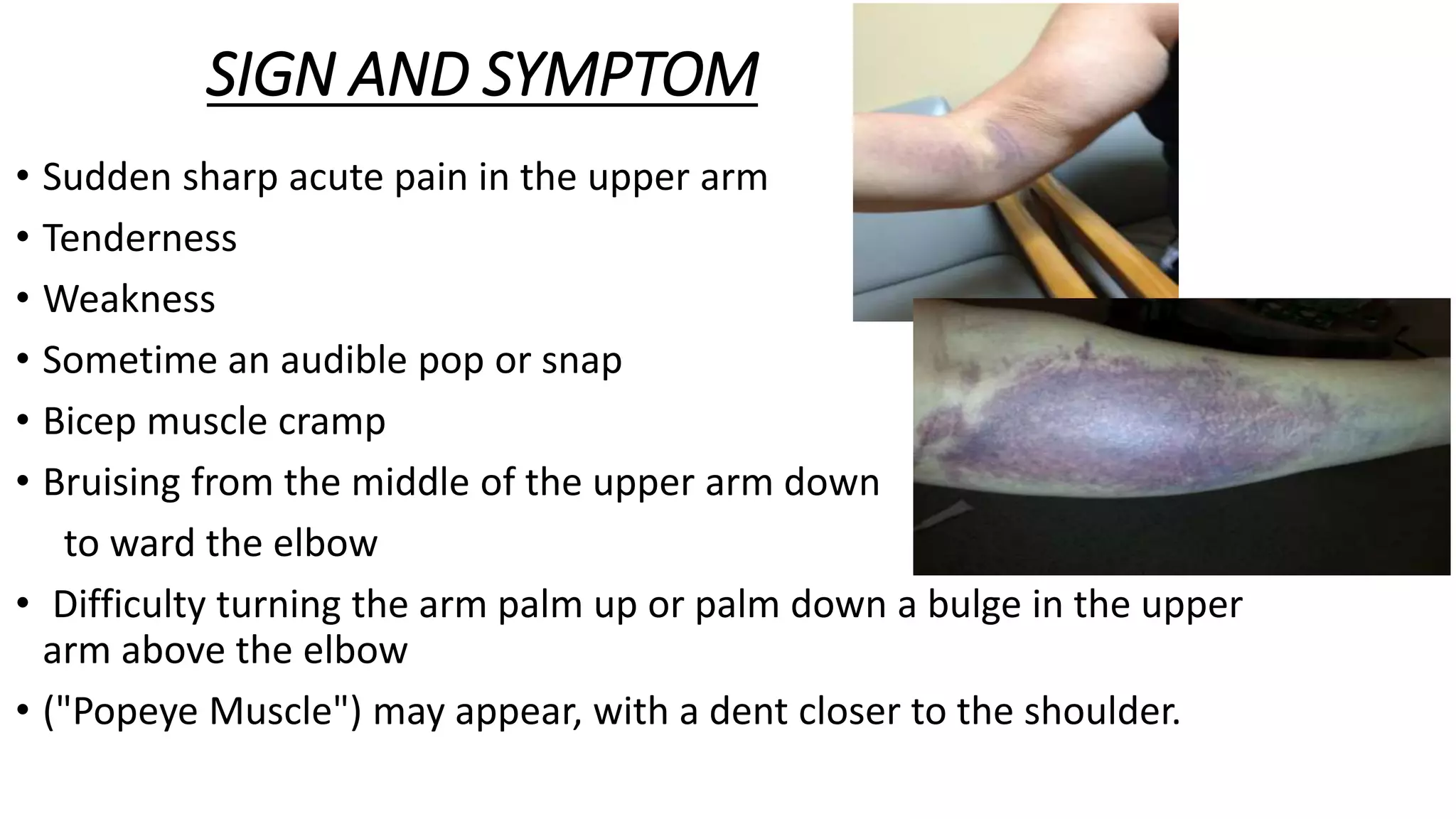 Biceps Rupture | PPTX