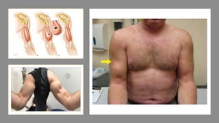 Biceps Rupture | PPTX