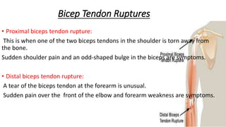 Biceps Rupture | PPTX