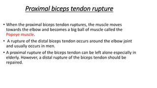 Biceps Rupture | PPTX