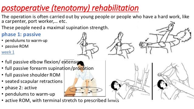 Biceps Rupture