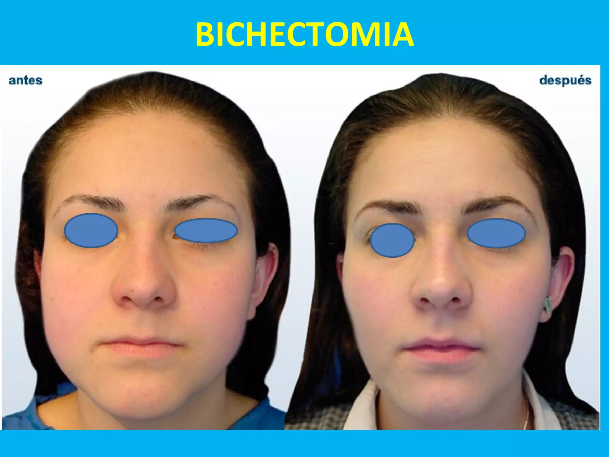 Bichectomia y lipo papada slideshare | PPT