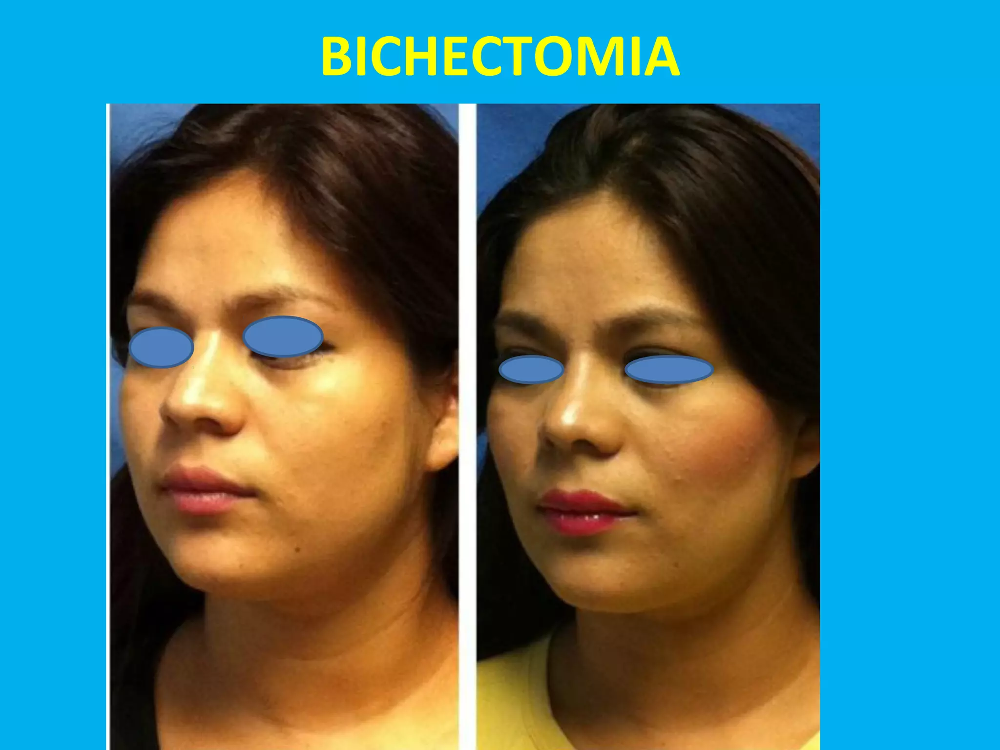 Bichectomia y lipo papada slideshare | PPT
