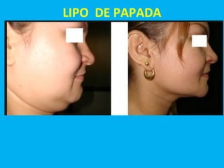 Bichectomia y lipo papada slideshare | PPT