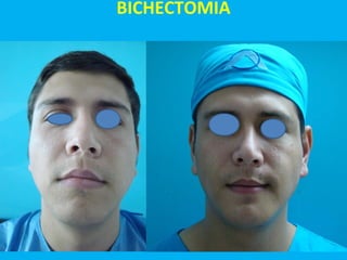 Bichectomia y lipo papada slideshare | PPT