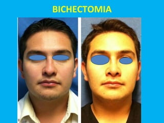 Bichectomia y lipo papada slideshare | PPT