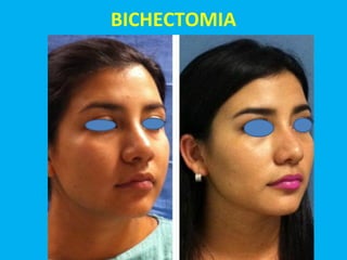 Bichectomia y lipo papada slideshare | PPT