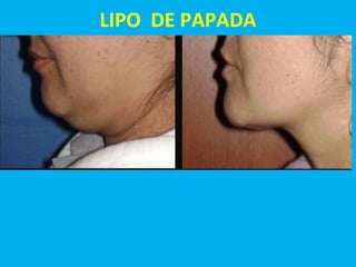 Bichectomia y lipo papada slideshare | PPT