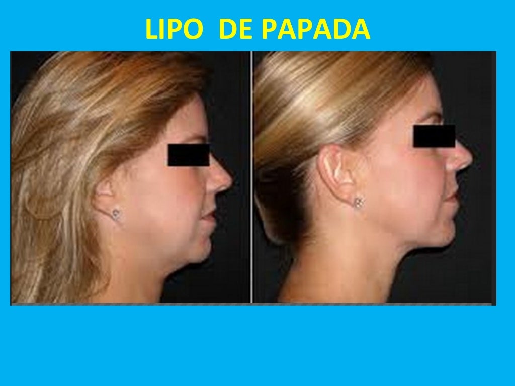 Bichectomia y lipo papada slideshare