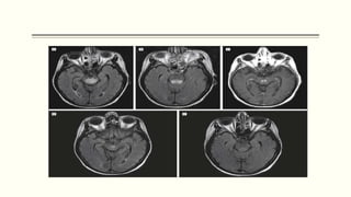 Bickerstaff brainstem encephalitis | PPTX