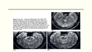 Bickerstaff brainstem encephalitis | PPTX