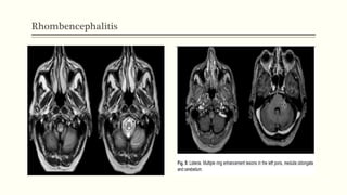 Bickerstaff brainstem encephalitis | PPTX