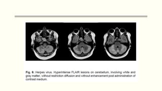 Bickerstaff brainstem encephalitis | PPTX