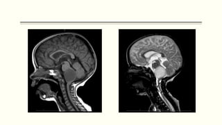 Bickerstaff brainstem encephalitis | PPTX