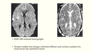 Bickerstaff brainstem encephalitis | PPTX