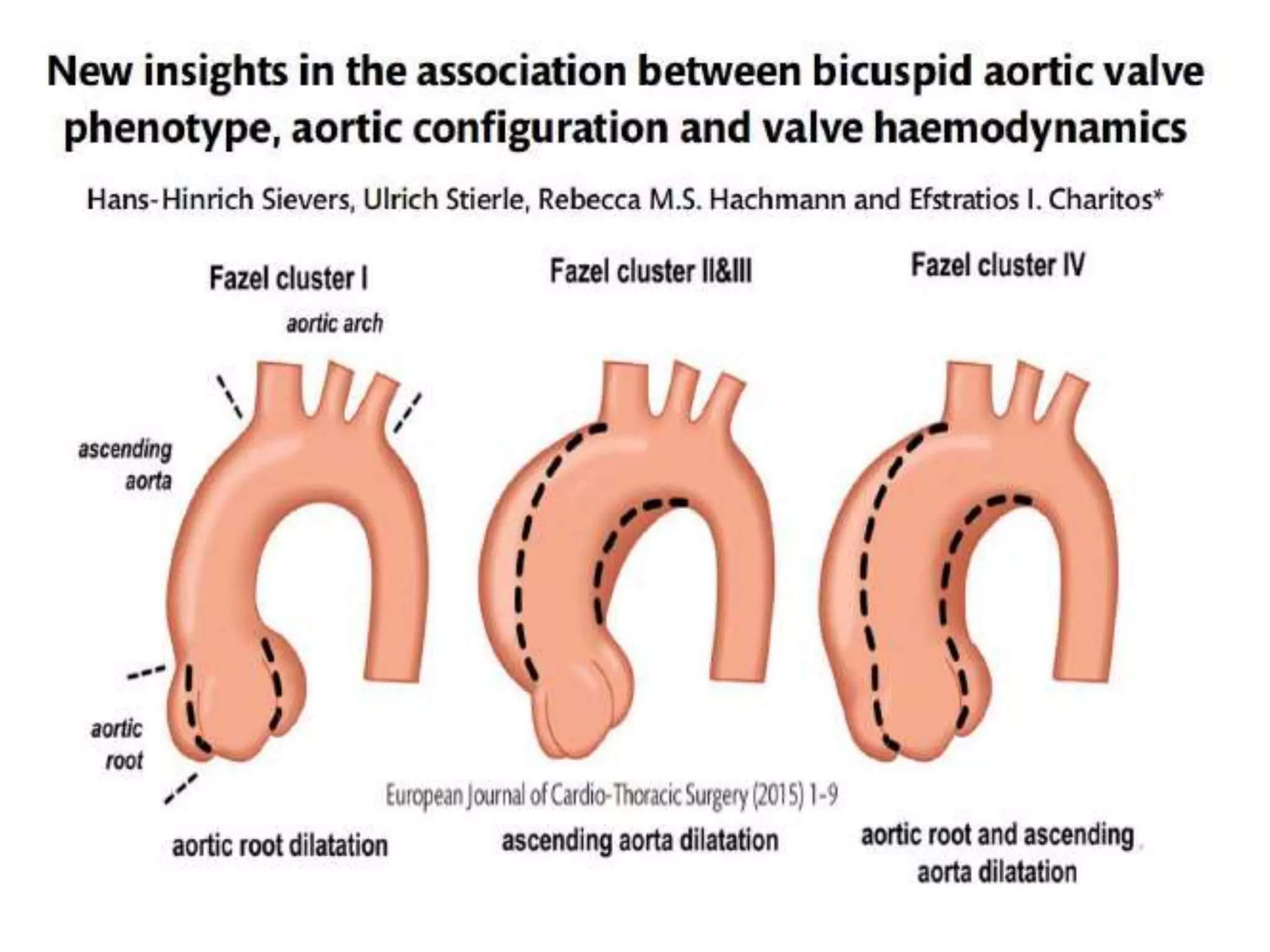 Bicuspid aortic valve | PPTX