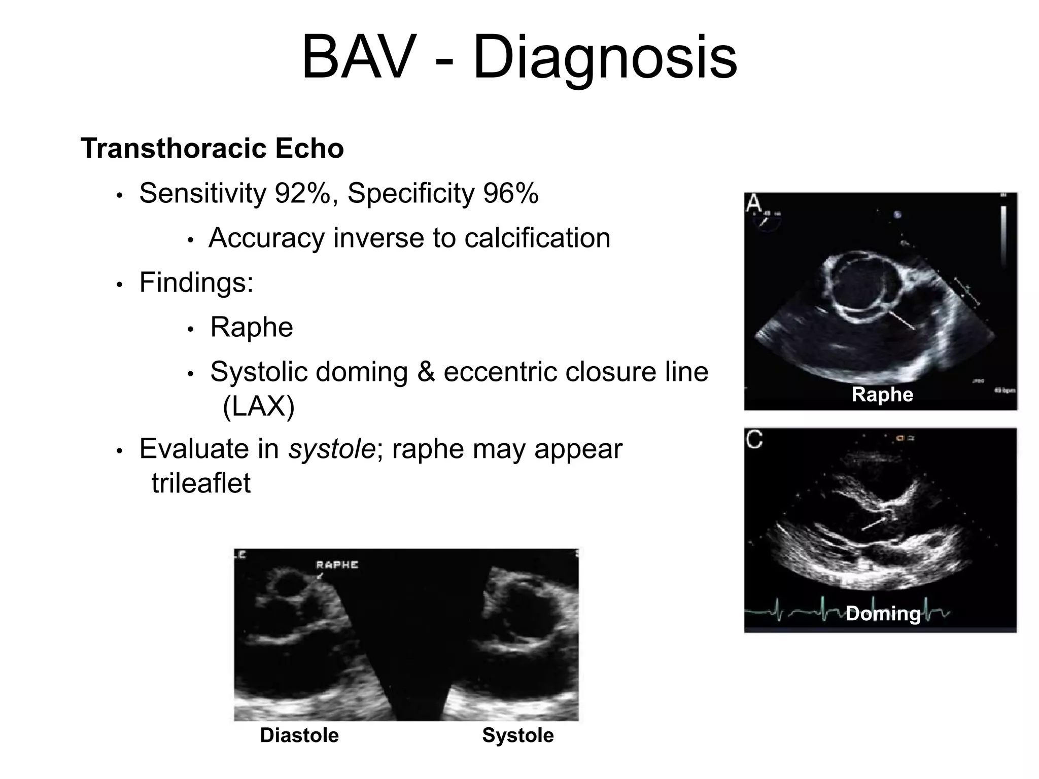 Bicuspid aortic valve | PPTX