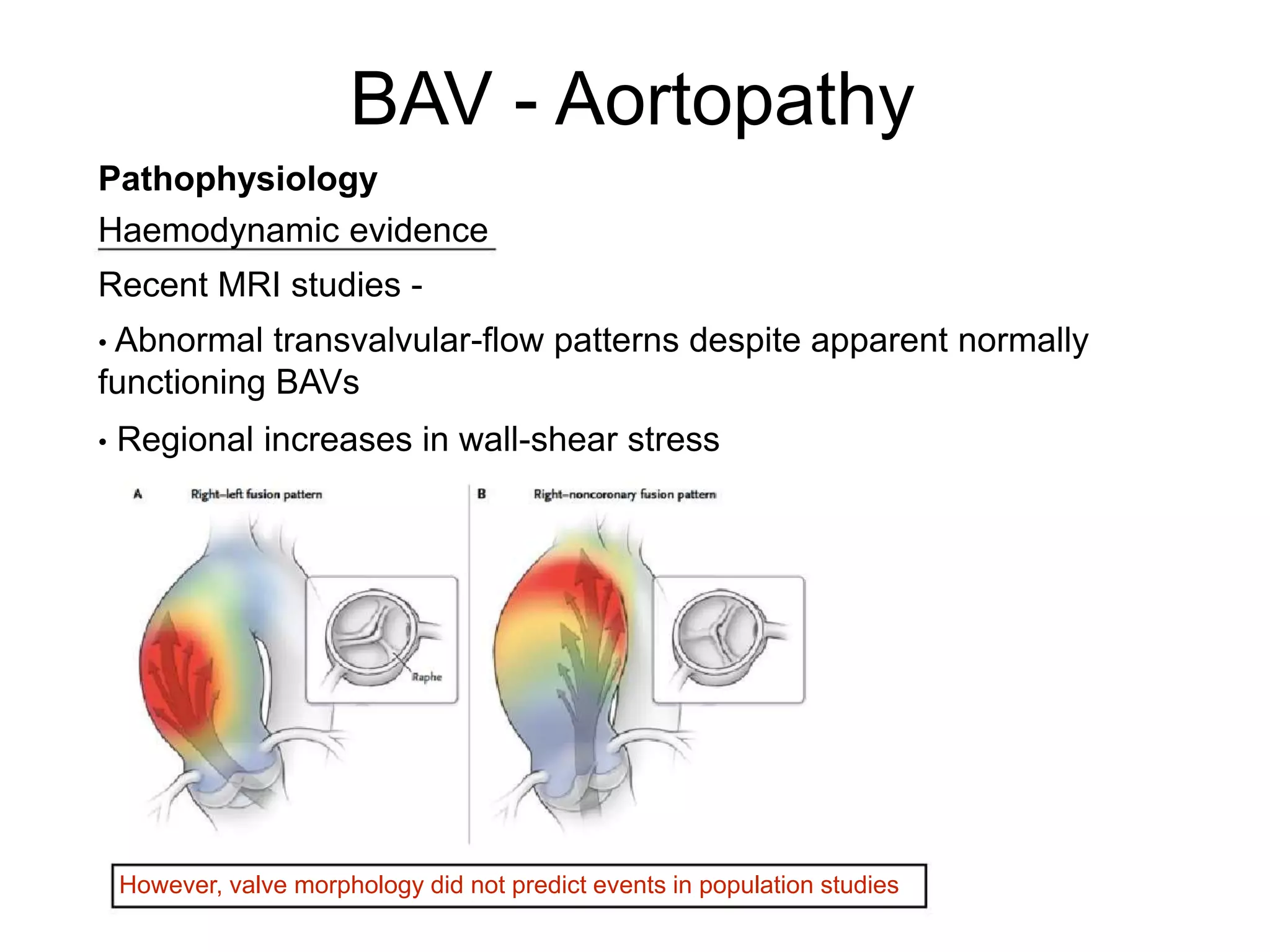 Bicuspid aortic valve | PPTX